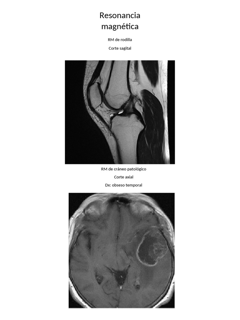 Resonancia Magnética: RM de Rodilla Corte Sagital | PDF