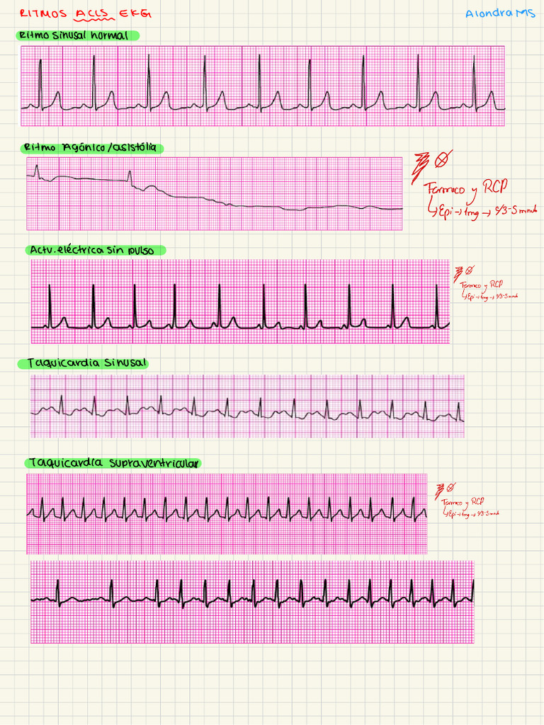 EKG ACLS | PDF | Reanimación cardiopulmonar | Corazón