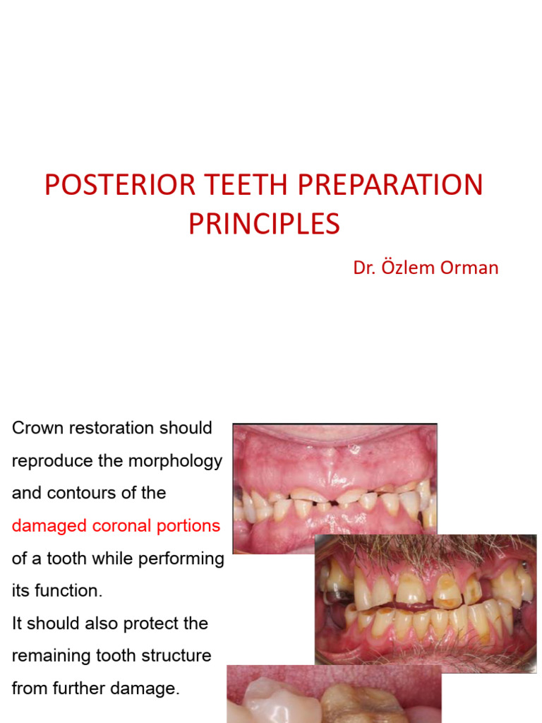 Principles of Posterior Tooth Preparation | PDF | Dentistry Branches ...
