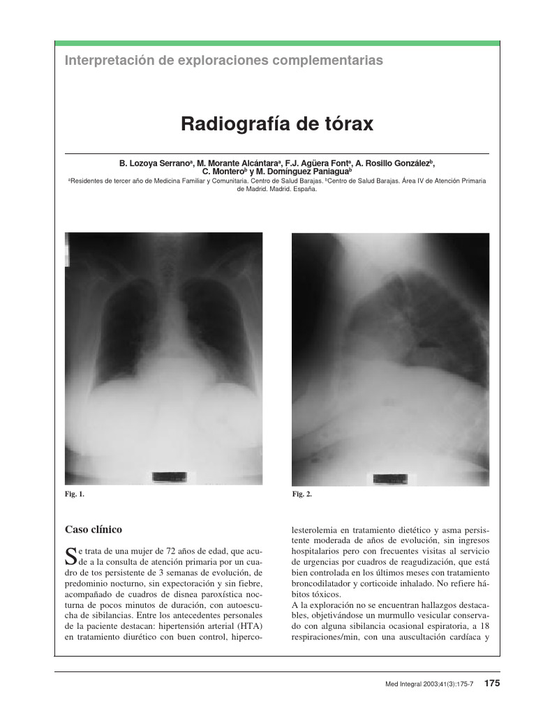 Radiografía de Tórax: Interpretación de Exploraciones Complementarias | PDF | La enfermedad por ...