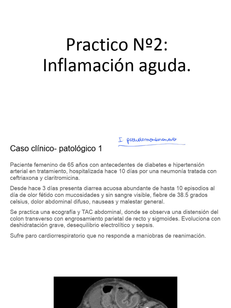 Casos Clinicos Necrosis-Inflamación Aguda_250325_084406 | PDF ...