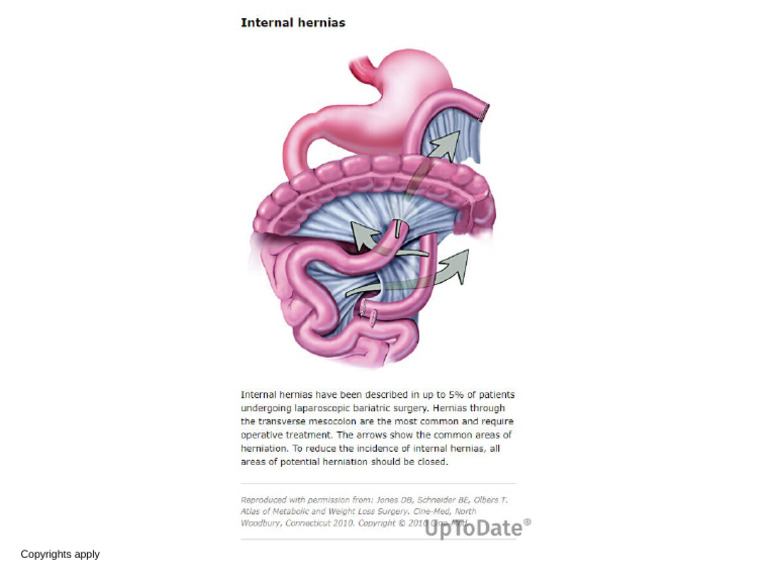 Hernie Interne 2 | PDF