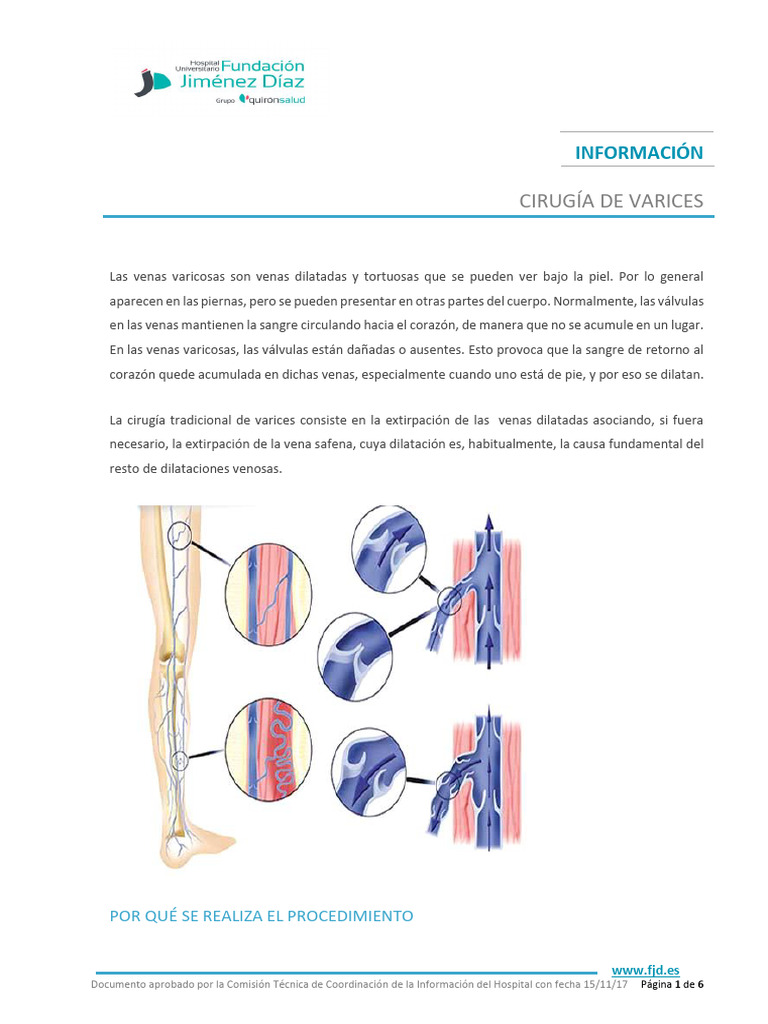 Cirugía de Varices: Procedimiento y Cuidados | PDF | Venas varicosas ...