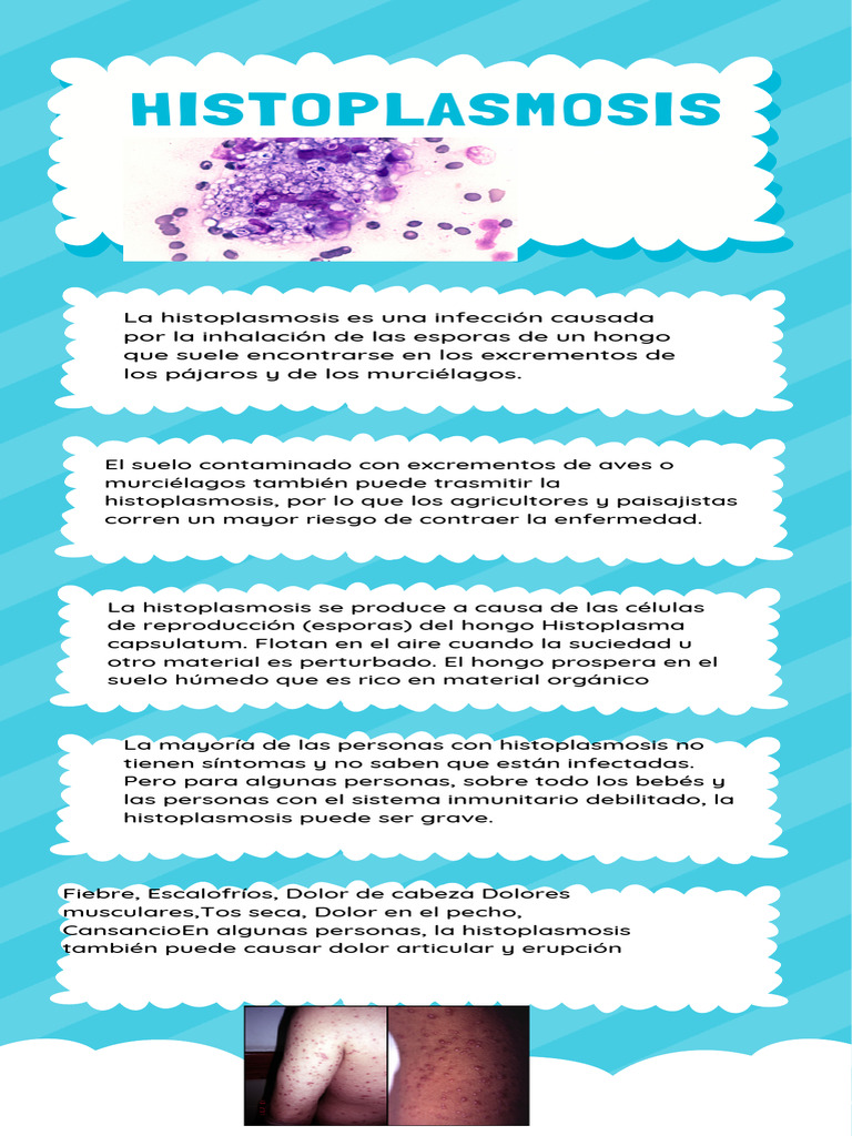 Histoplasmosis: Síntomas y Tratamiento | PDF