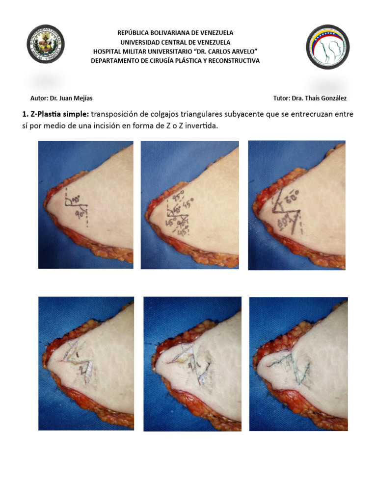 Técnicas de Z-Plastia y Colgajos en Cirugía | PDF