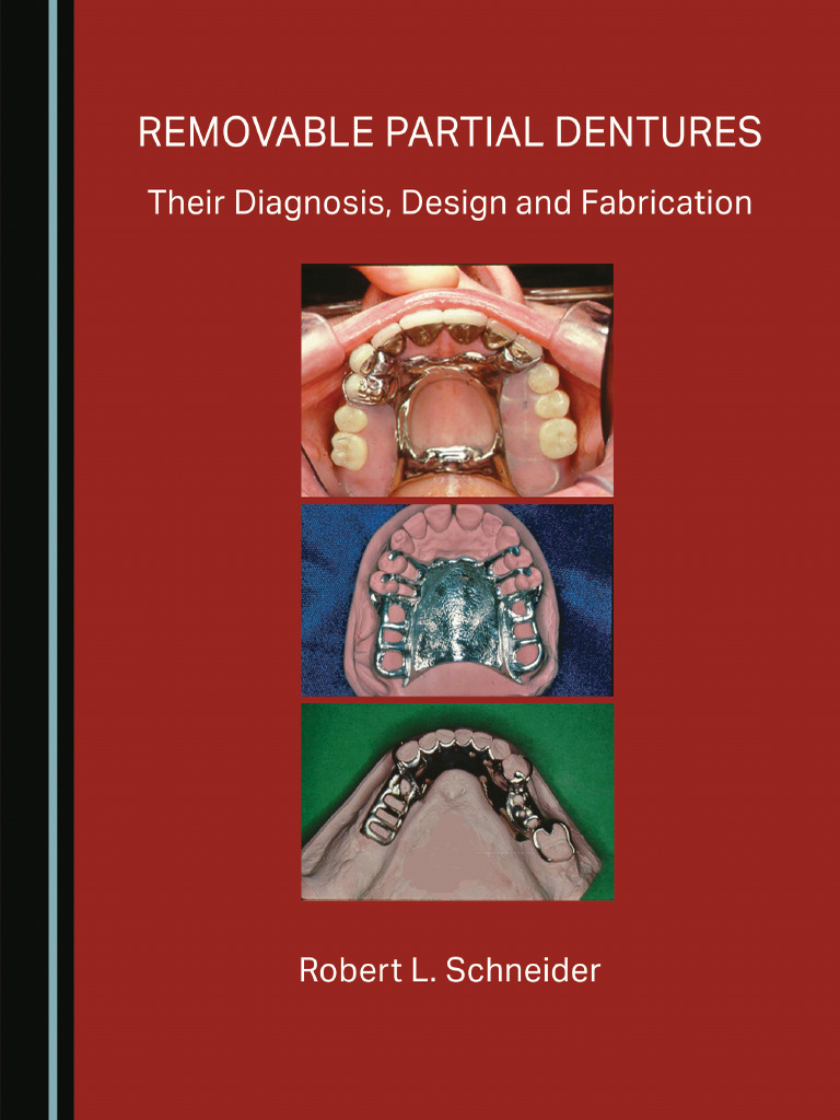Removable Partial Dentures_ Their Diagnosis, Design and Fabrication ...
