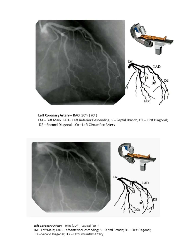 Left Coronary Artery Angiogram-Rao | PDF