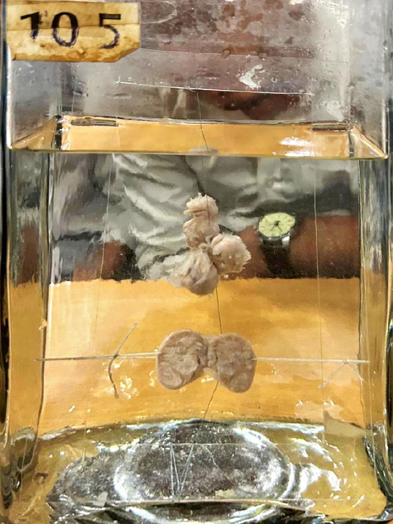 pathology specimen | PDF