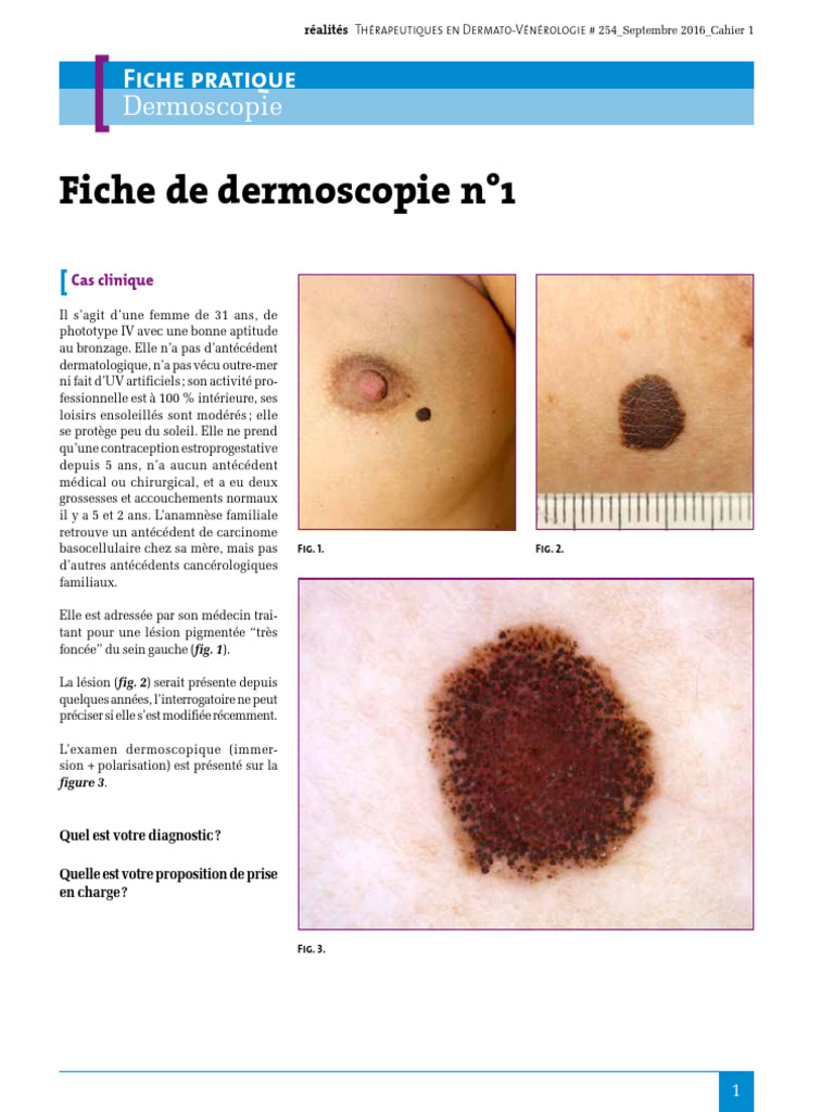 Diagnostic et prise en charge du mélanome | PDF | Mélanome | Dermatologie
