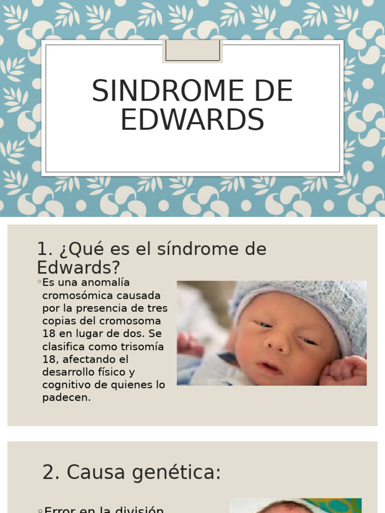 Sindrome de Edwards | PDF