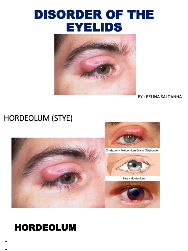 Disorder of The Eyelids | PDF | Diseases And Disorders | Human Diseases ...