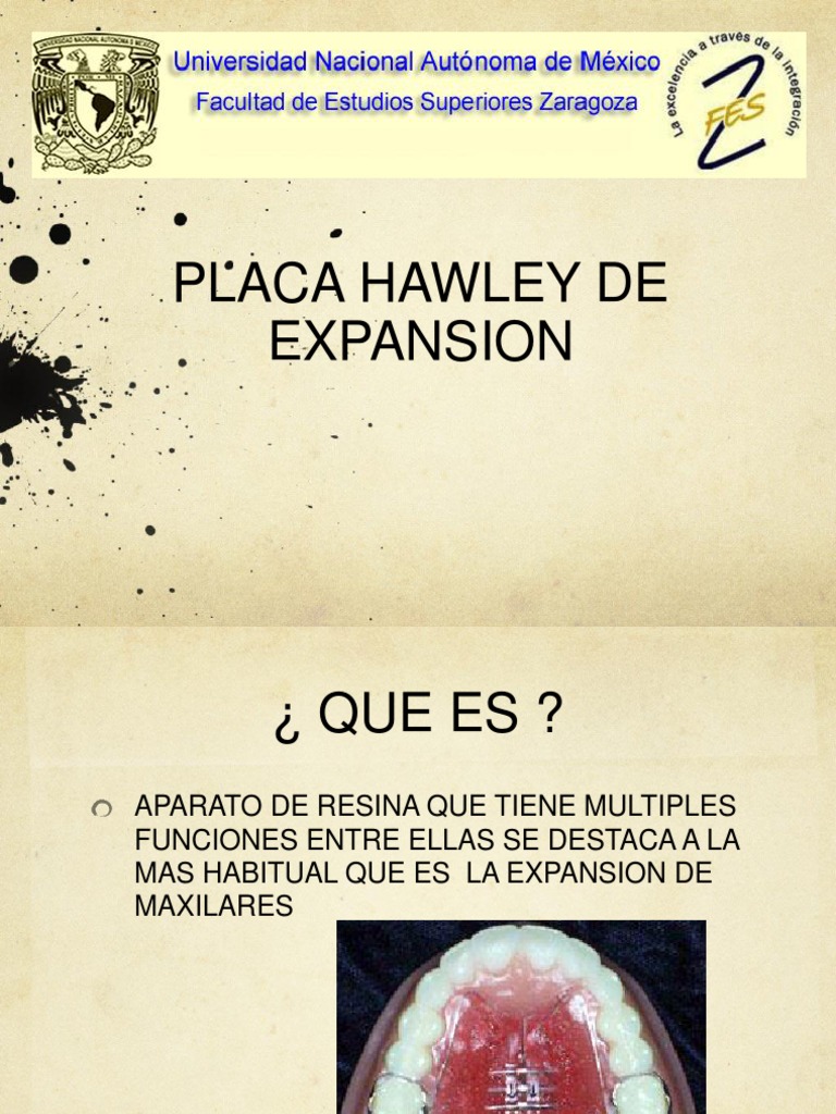 Placa Hawley | PDF