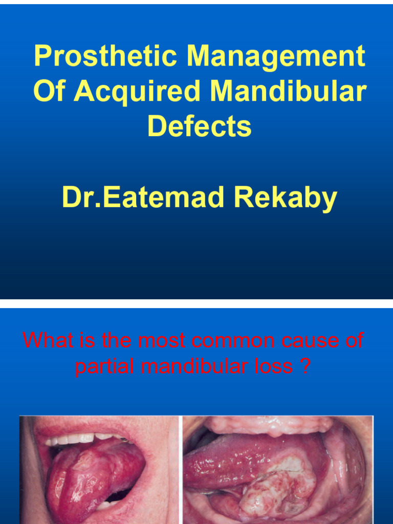Management of Mandibular Defects | PDF | Dentures | Dental Implant