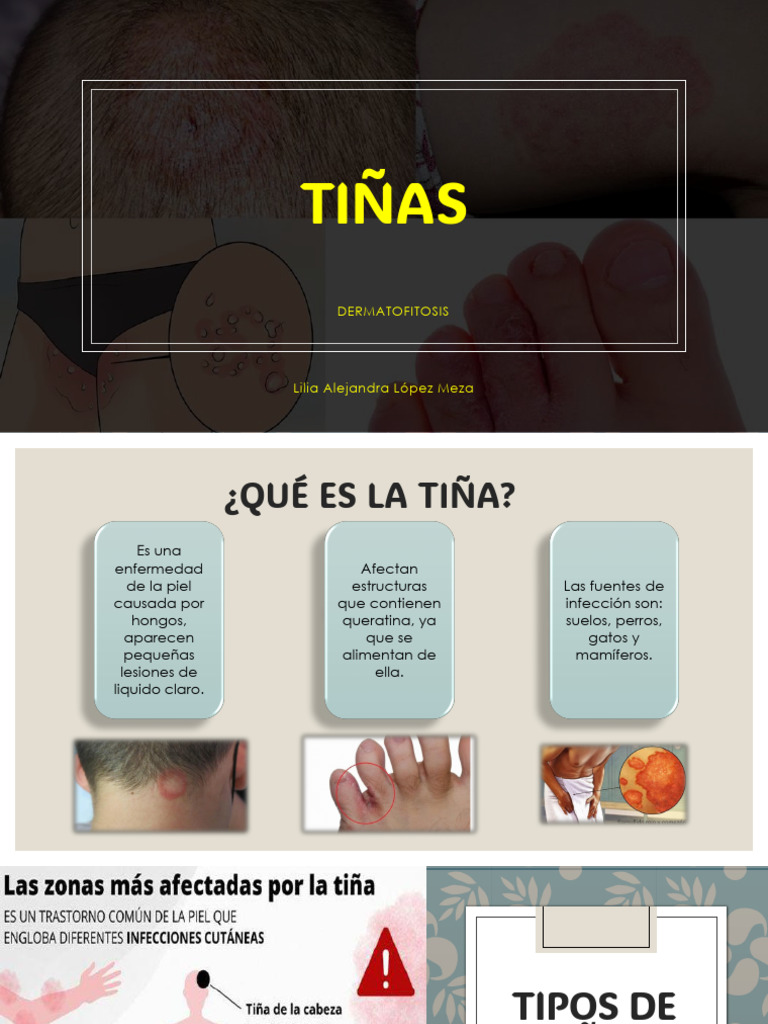 TIÑAS | PDF | Hongo | Micología