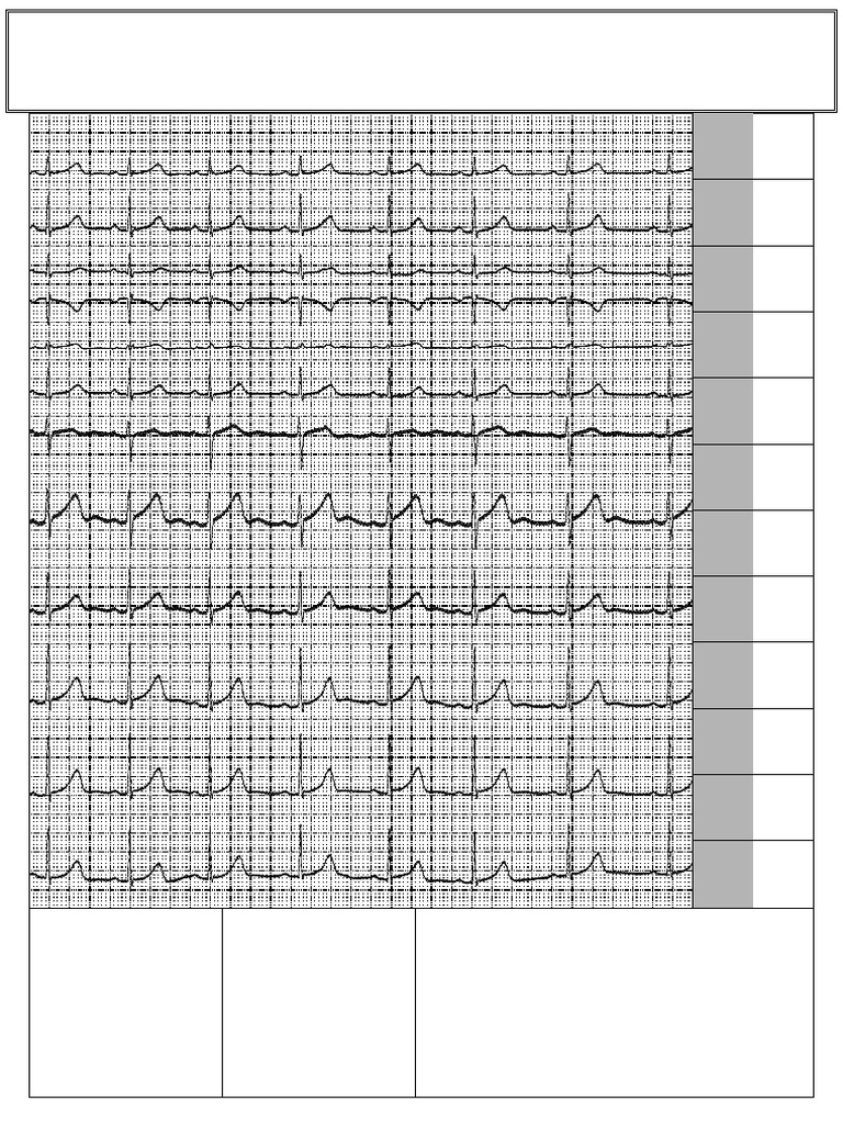 Informe ECG del Paciente Femenino | PDF | Electrofisiología cardíaca ...