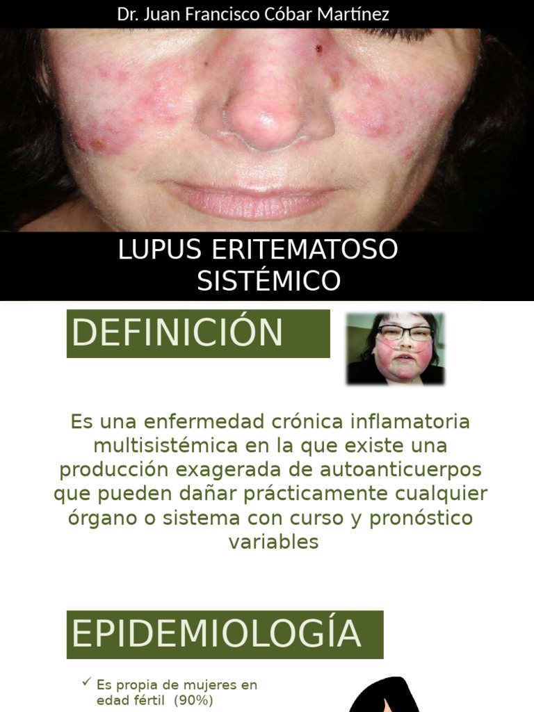 Lupus Eritematoso Sistémico: Guía Completa | PDF | Medicina CLINICA ...