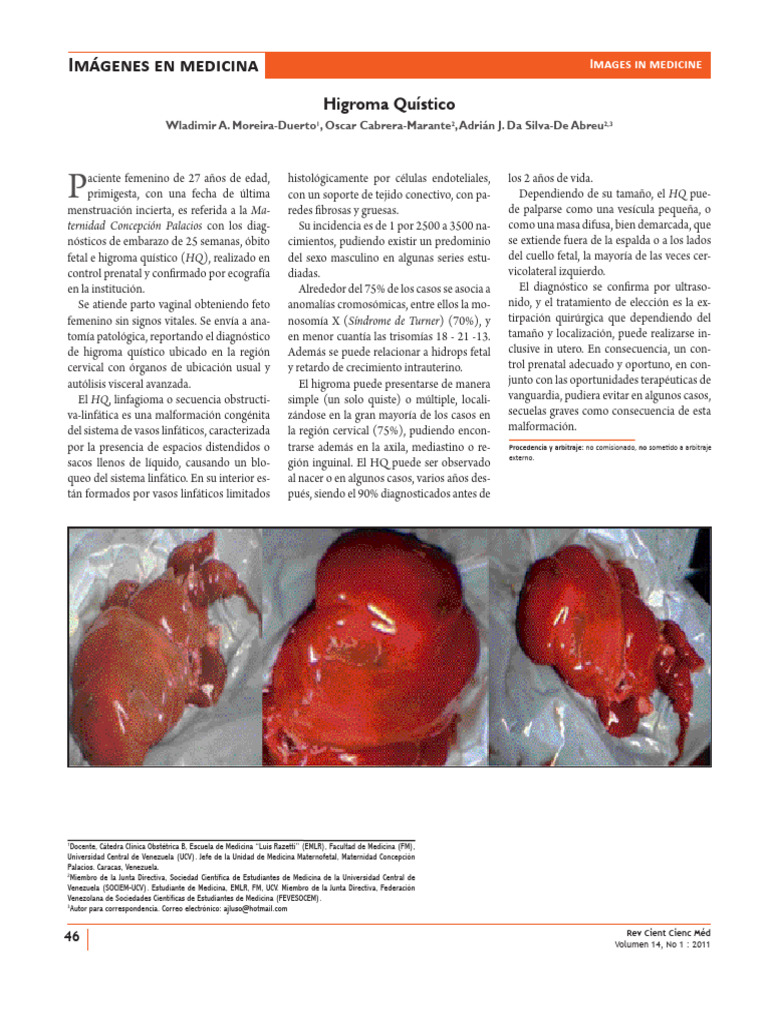 Higroma Quístico: Diagnóstico y Manejo | PDF | Enfermedades y ...