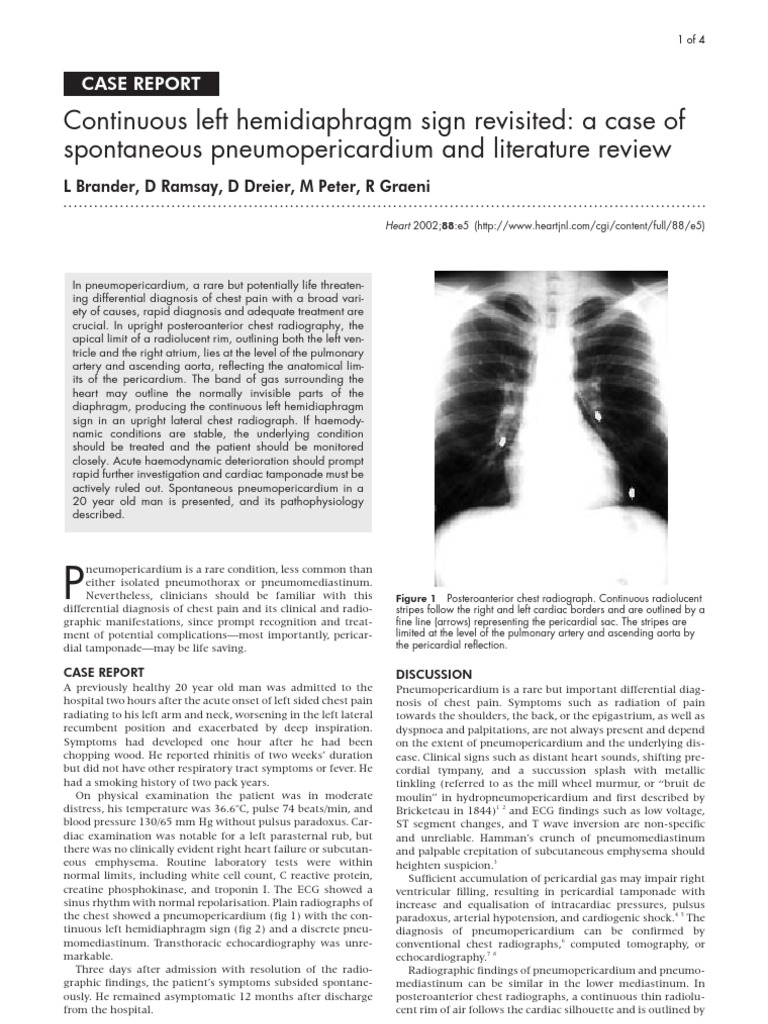 Continuous Left He Mi Diaphragm Sign Revisited 2002 | PDF | Heart | Aorta