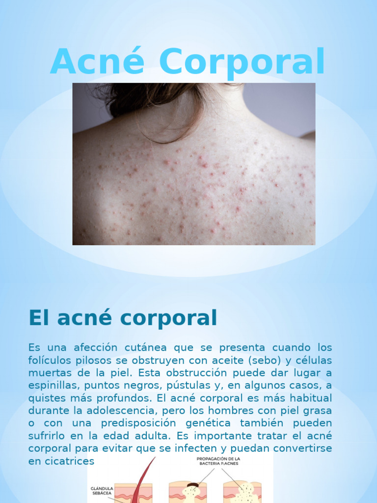 Acne Corporal | PDF | Especialidades Medicas