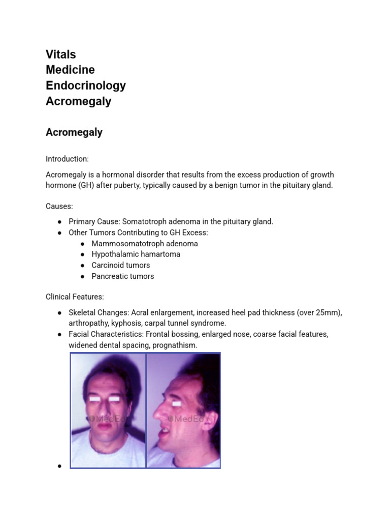 Acromegaly: Causes, Features, and Treatment | PDF