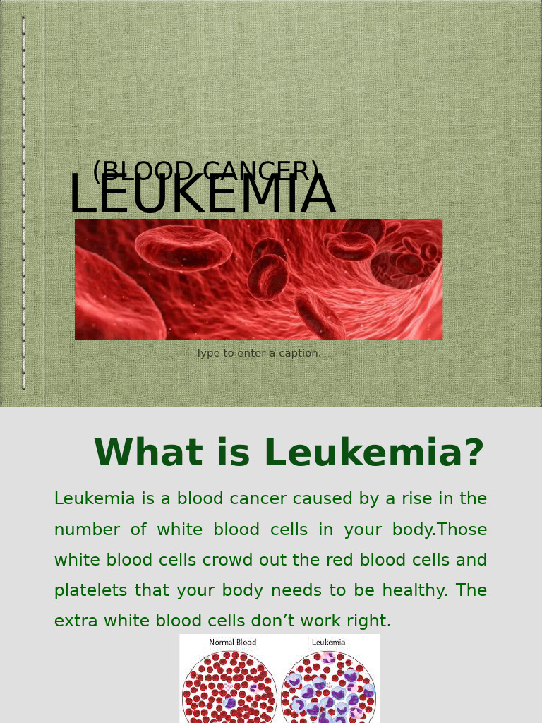 Leukemia Powerpoint2 | PDF | Leukemia | Cancer
