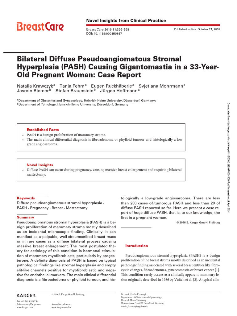 Bilateral Diffuse Pseudoangiomatous Stromal Hyperplasia (PASH) Causing Gigantomastia in A 33 ...