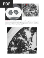 HRCT Chest Basic Interpretation | PDF | Lung | Medical Specialties