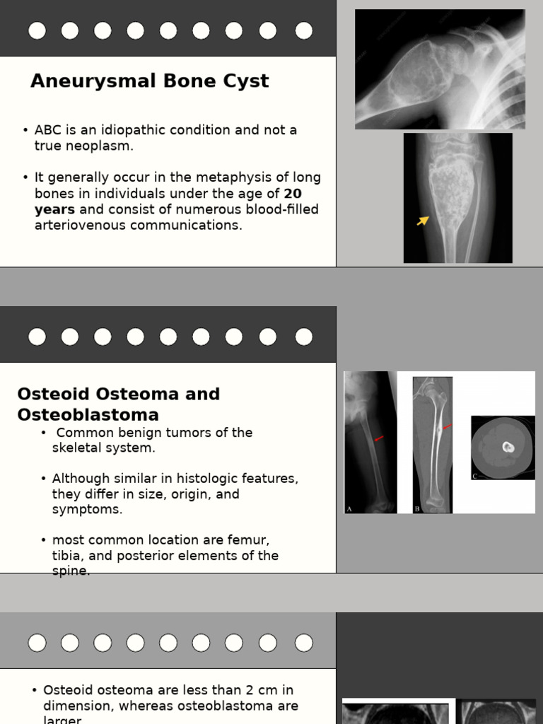 Aneurysmal Bone Cyst | PDF