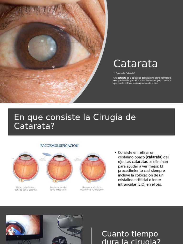 catarata.paginaFB | PDF