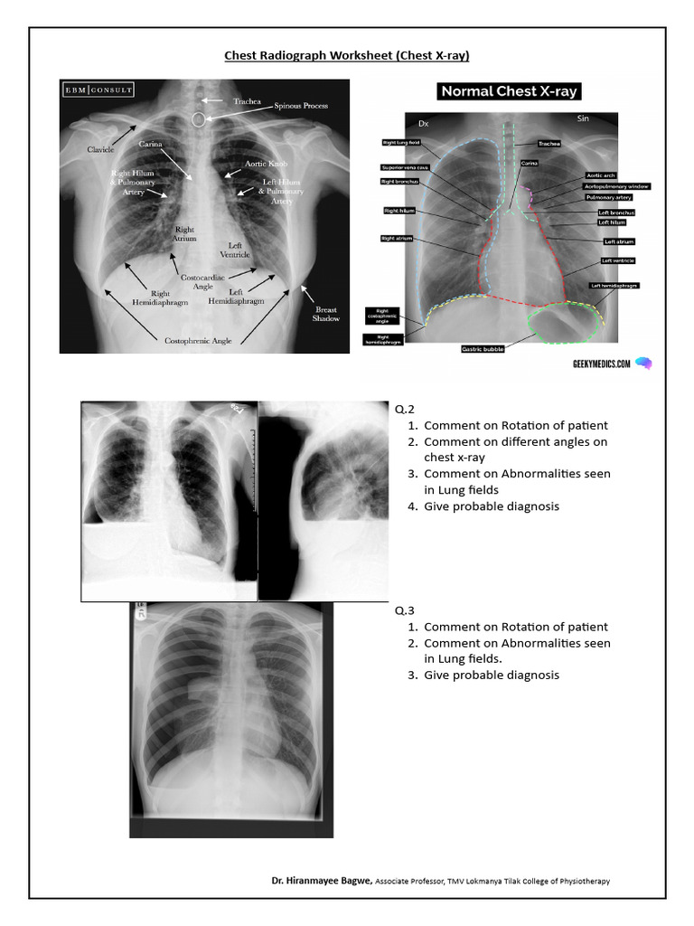 Chest X-ray Analysis Guide | PDF