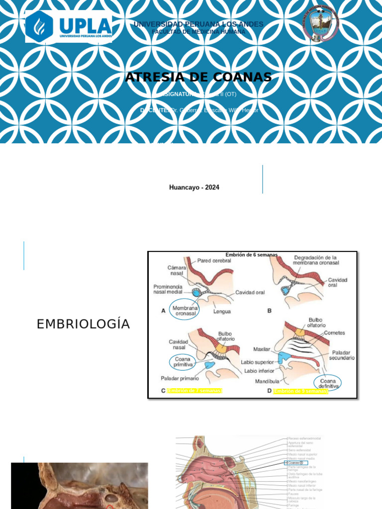 Atresia de Coanas | PDF | Síndrome | Enfermedades y trastornos