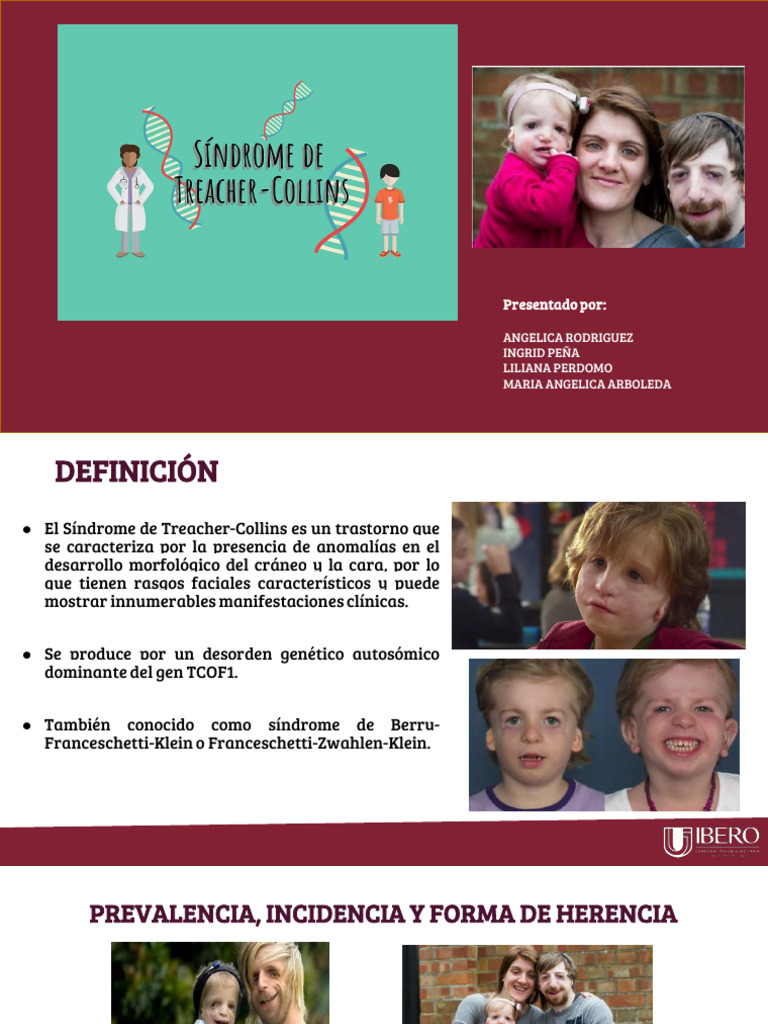 Síndrome de Treacher-Collins: Características y Diagnóstico | PDF ...