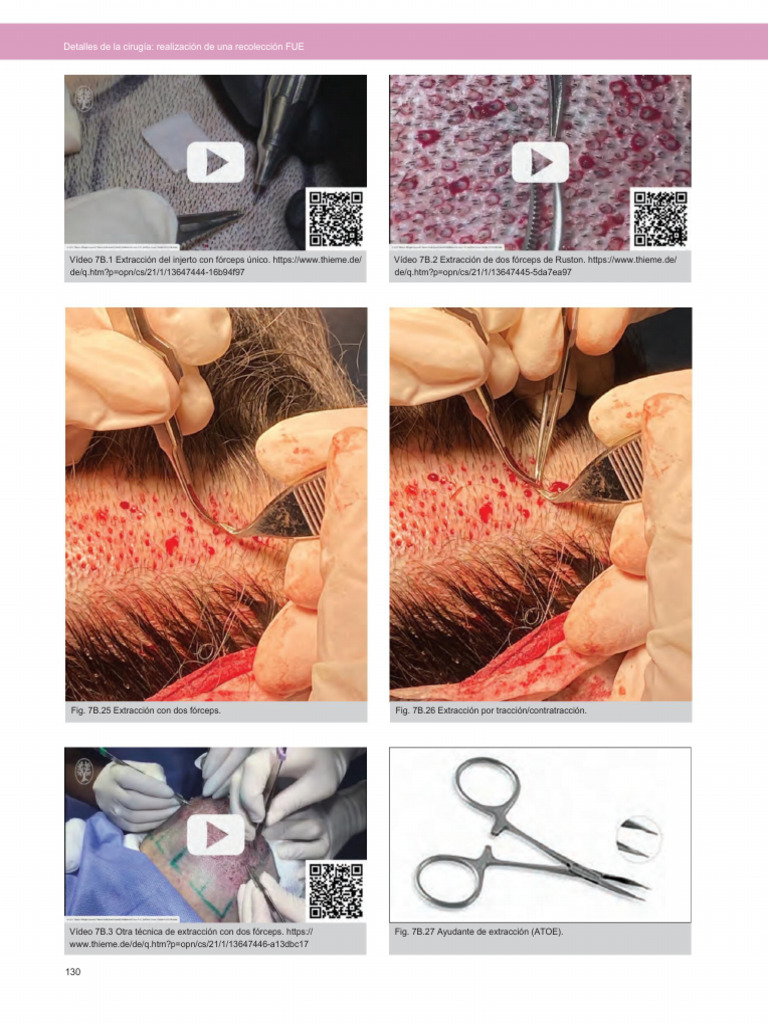 ESP Practical Guide To Hair Transplantation PRT 3 | PDF | Pelo | Perdida de cabello