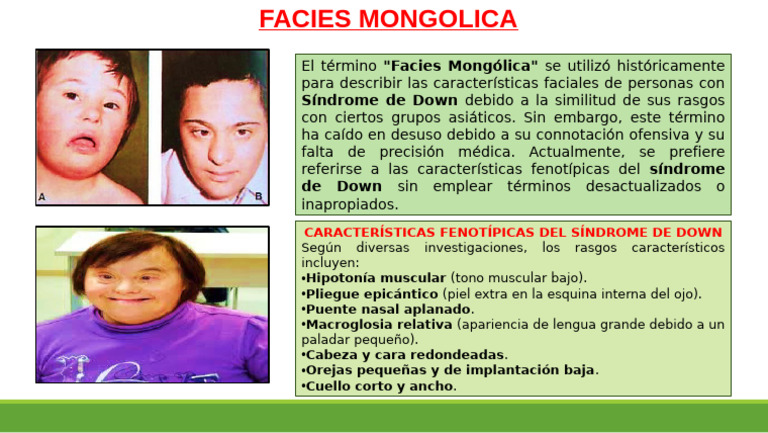 Características del Síndrome de Down | PDF