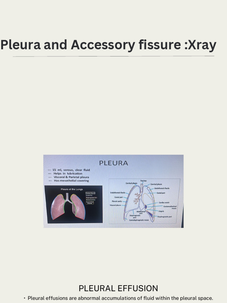 Pleural Effusion and Accessory Fissures X-ray | PDF