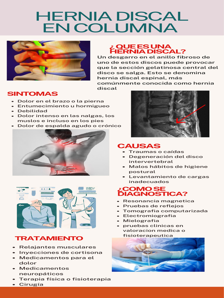 Infografia Hernia Discal | PDF