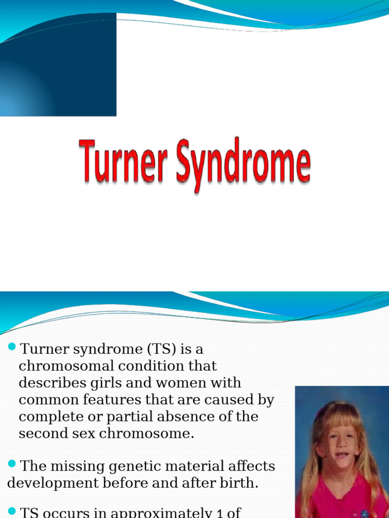 Lecture 13-14 Turner Syndrome | PDF | Genetics | Medical Specialties