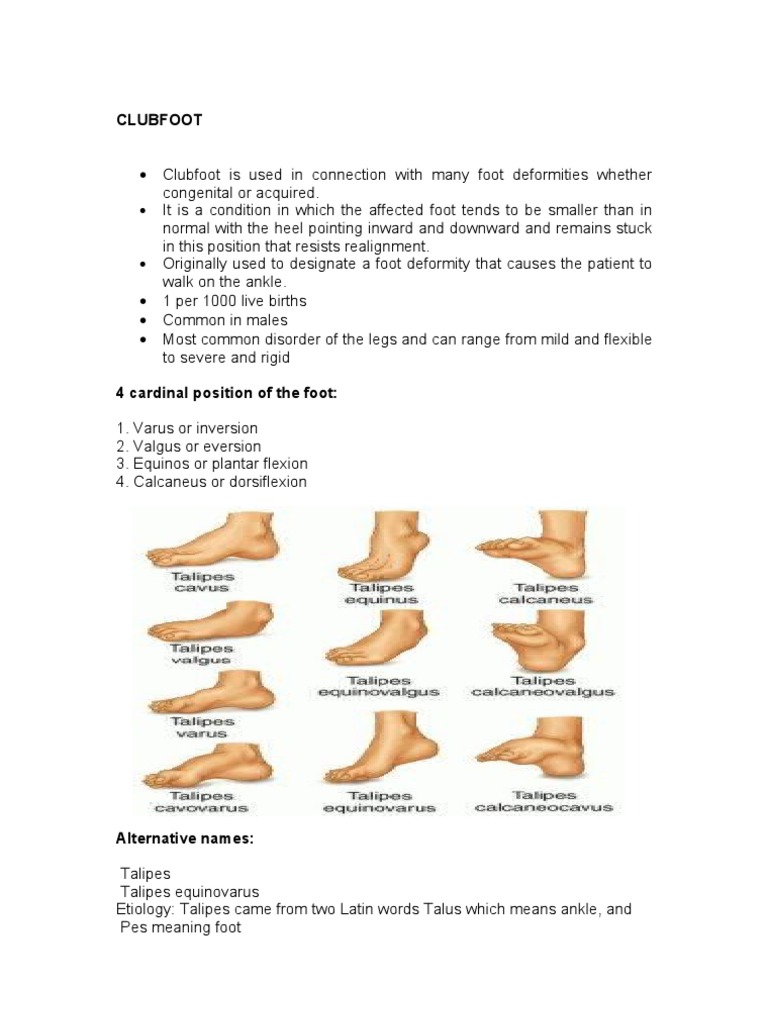 Clubfoot | PDF | Foot | Musculoskeletal System