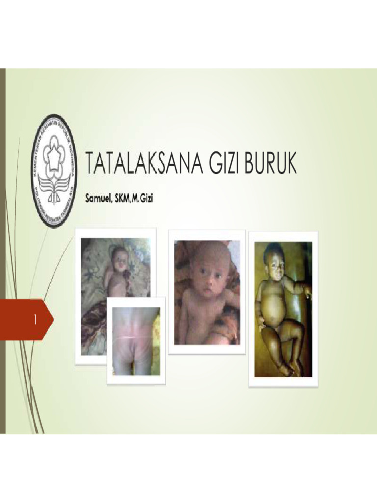 Konsep Tatalaksana Gizi Buruk | PDF