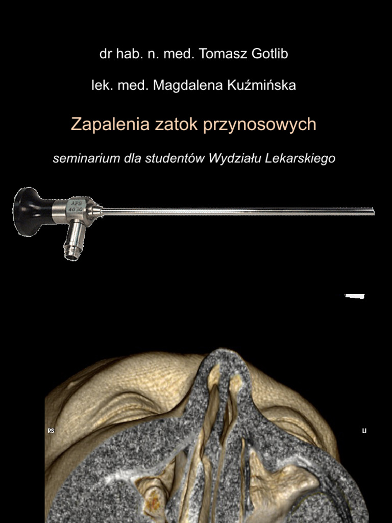 Zapalenia Zatok | PDF