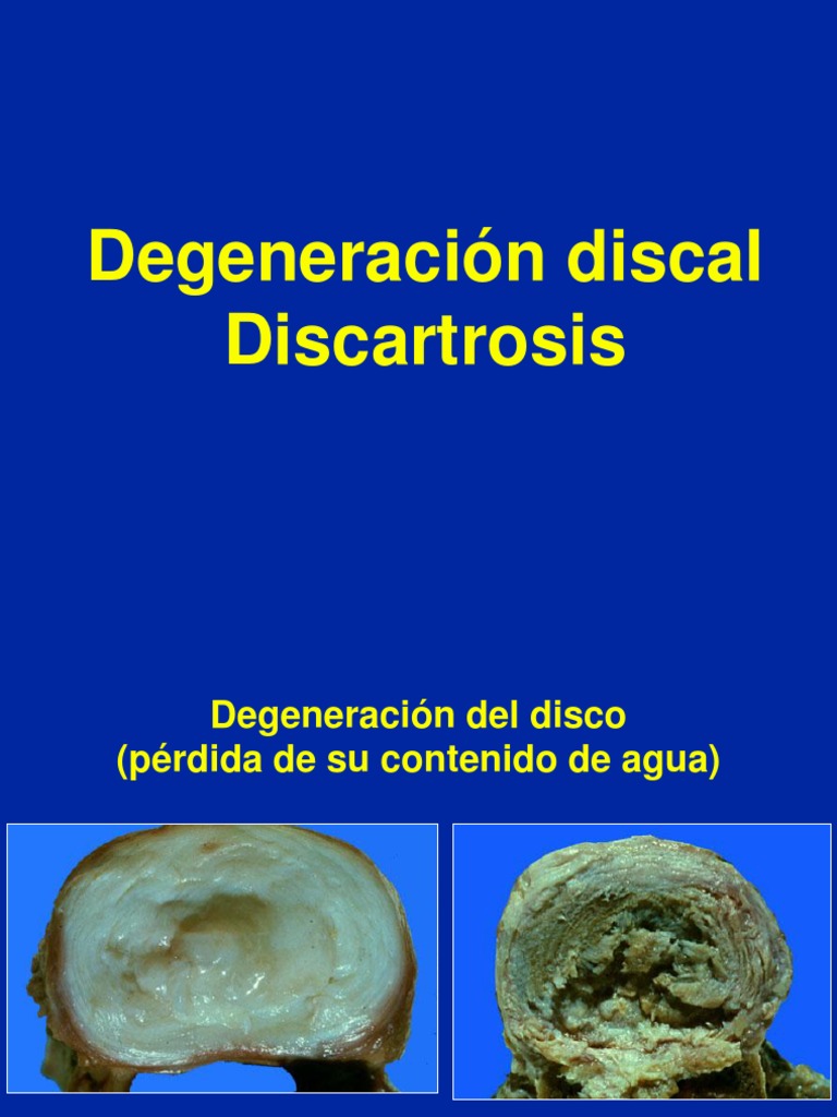 3 - Discartrosis | PDF | Sistema musculoesquelético | Tórax (anatomía ...