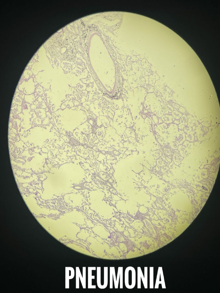 Patho-Pneumonia, Squamous Cell Papilloma | PDF