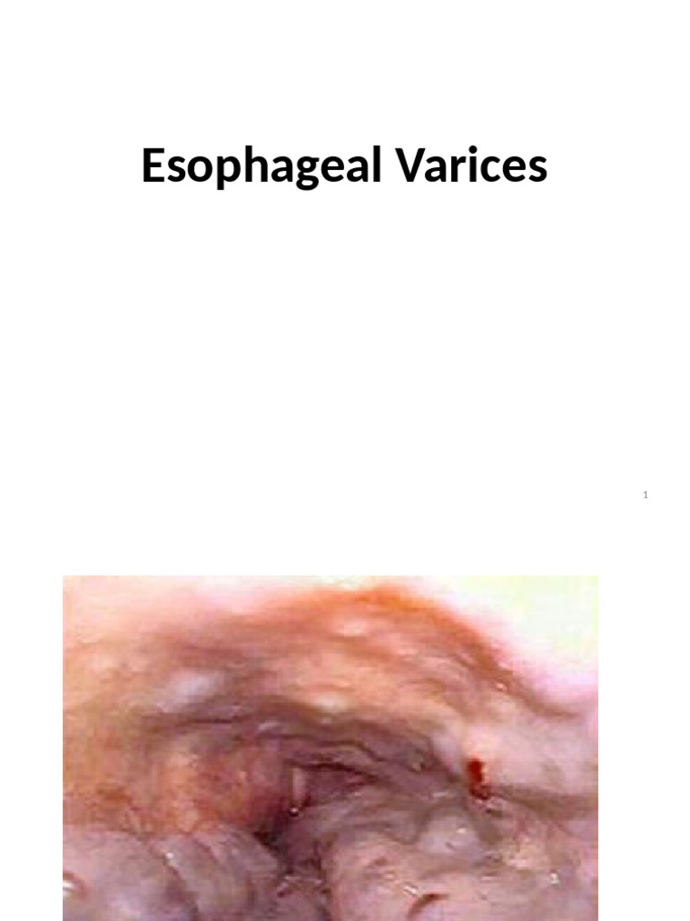Understanding Esophageal Varices Risks | PDF | Esophagus | Vein