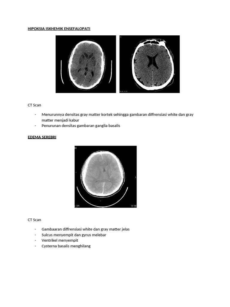 Hipoksia Iskhemik Ensefalopati | PDF