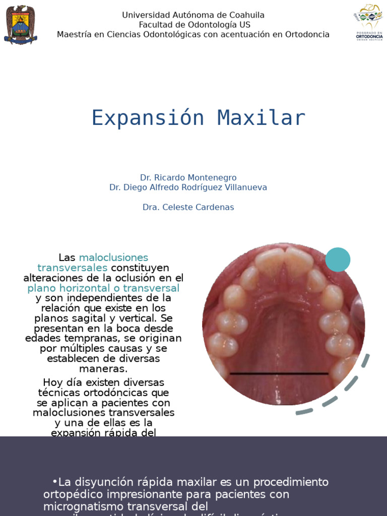 Expansión Maxilar con Disyuntor Hyrax | PDF | Odontología | Ortodoncia