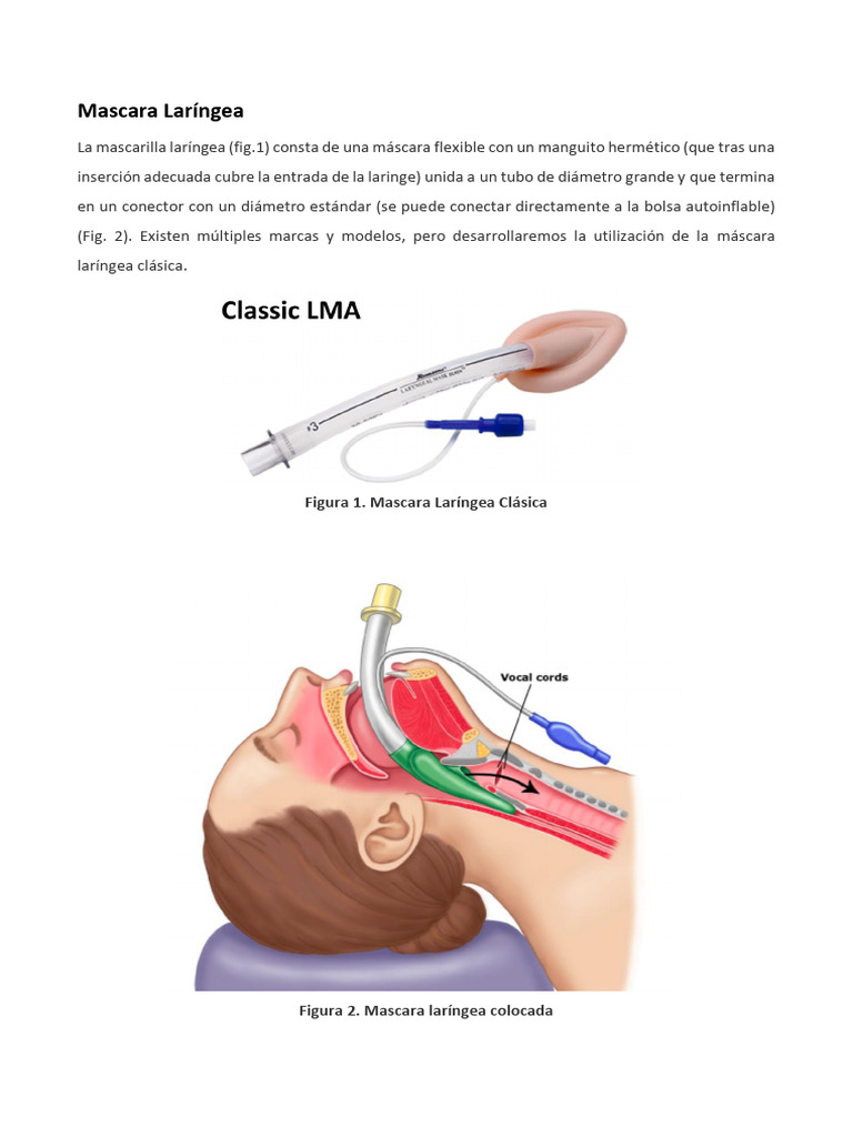 Colocación de la Mascarilla Laríngea | PDF | Reanimación cardiopulmonar ...
