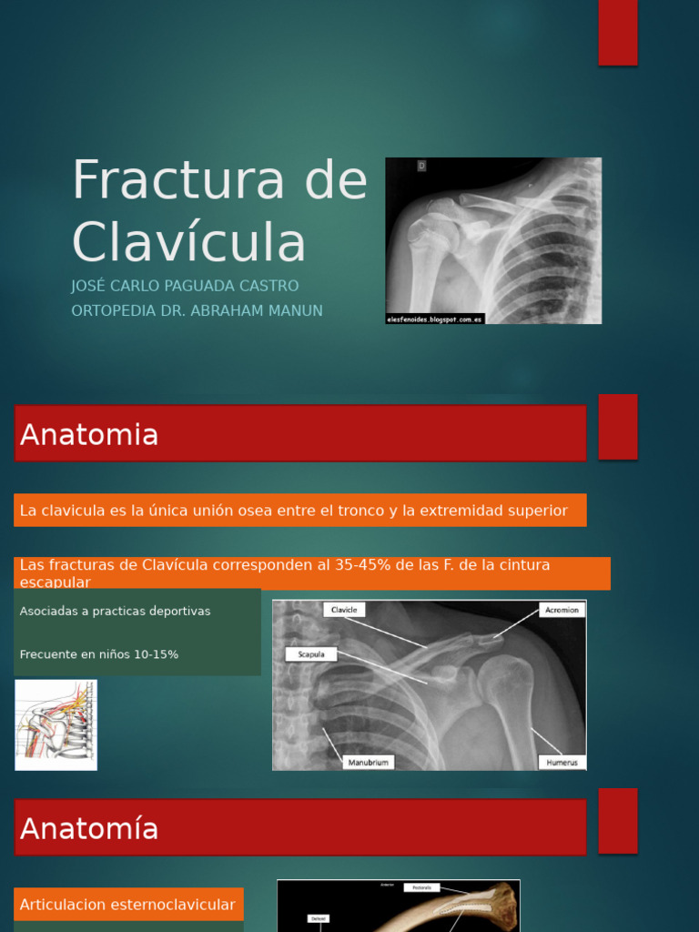 Fractura de Clavícula | PDF | Extremidades (anatomía) | Hombro