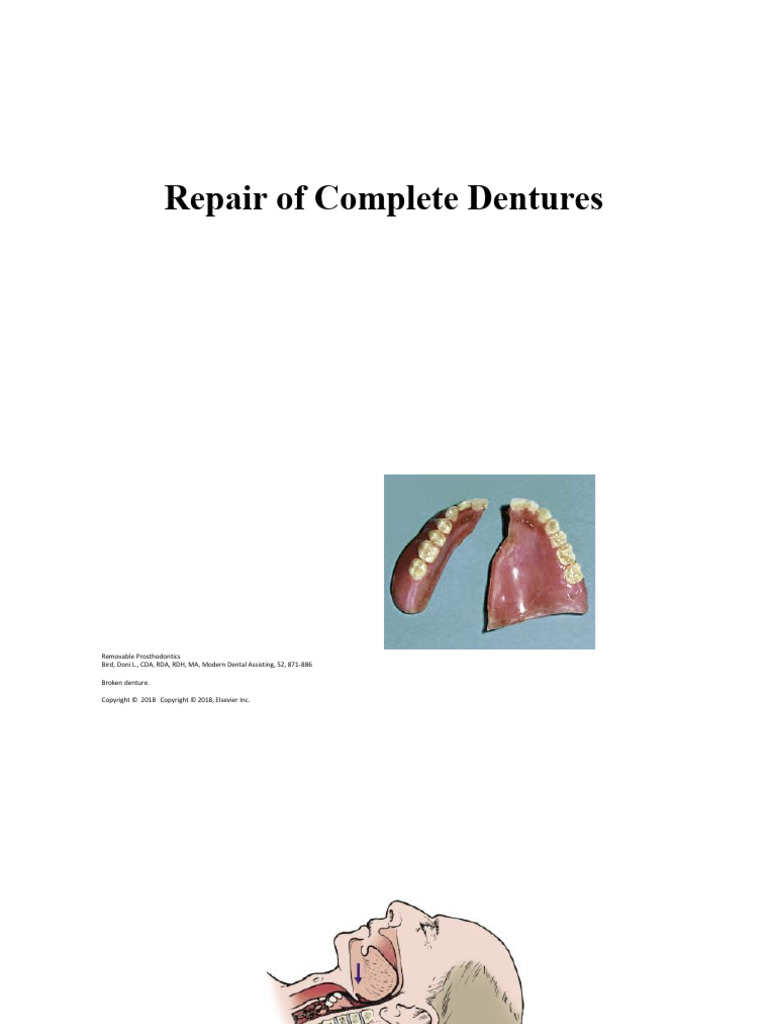 Repair of Complete Dentures | PDF | Dentures | Prosthodontics