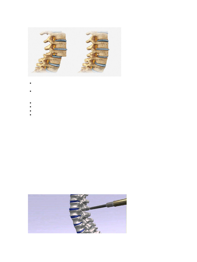 Síntomas de La Listesis | PDF | Dolor de espalda | Medicina CLINICA