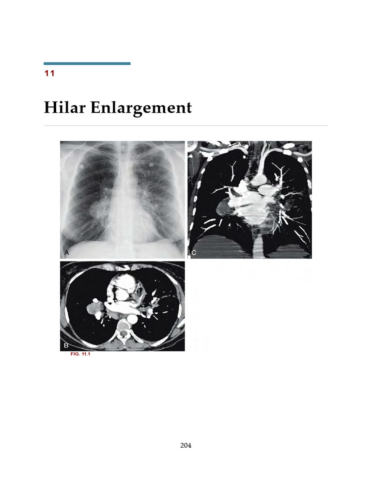 Causes of Hilar Enlargement in Lungs | PDF | Lung | Heart